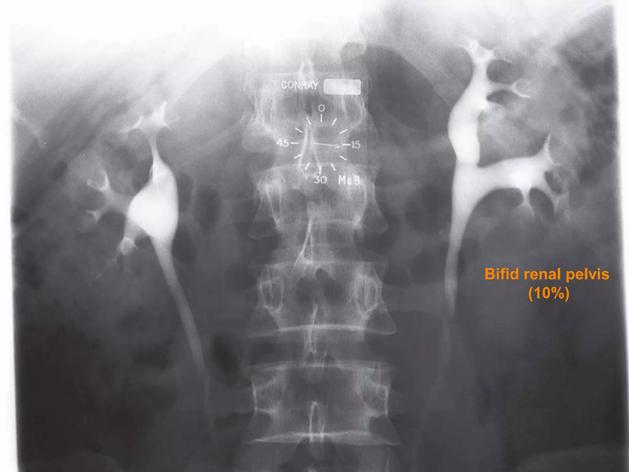 Kub - xray and usg | PPTX