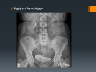 Kub - xray and usg | PPTX