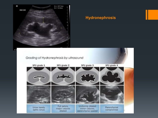Kub - xray and usg | PPTX