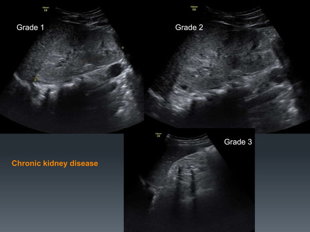 Kub - xray and usg | PPTX