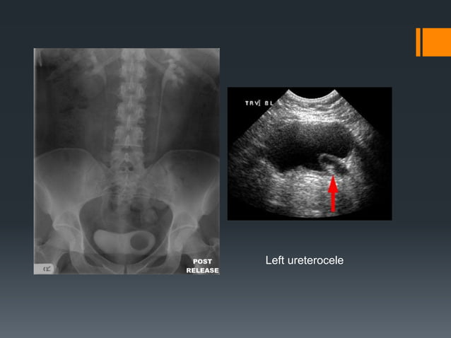 Kub - xray and usg | PPTX