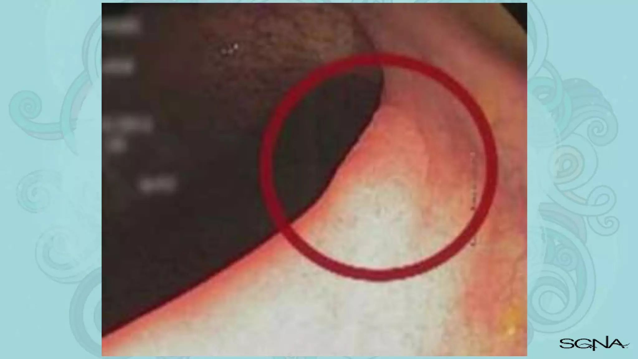 Kudos To You: Learning your Kudo Pit Patterns and Paris Polyp ...