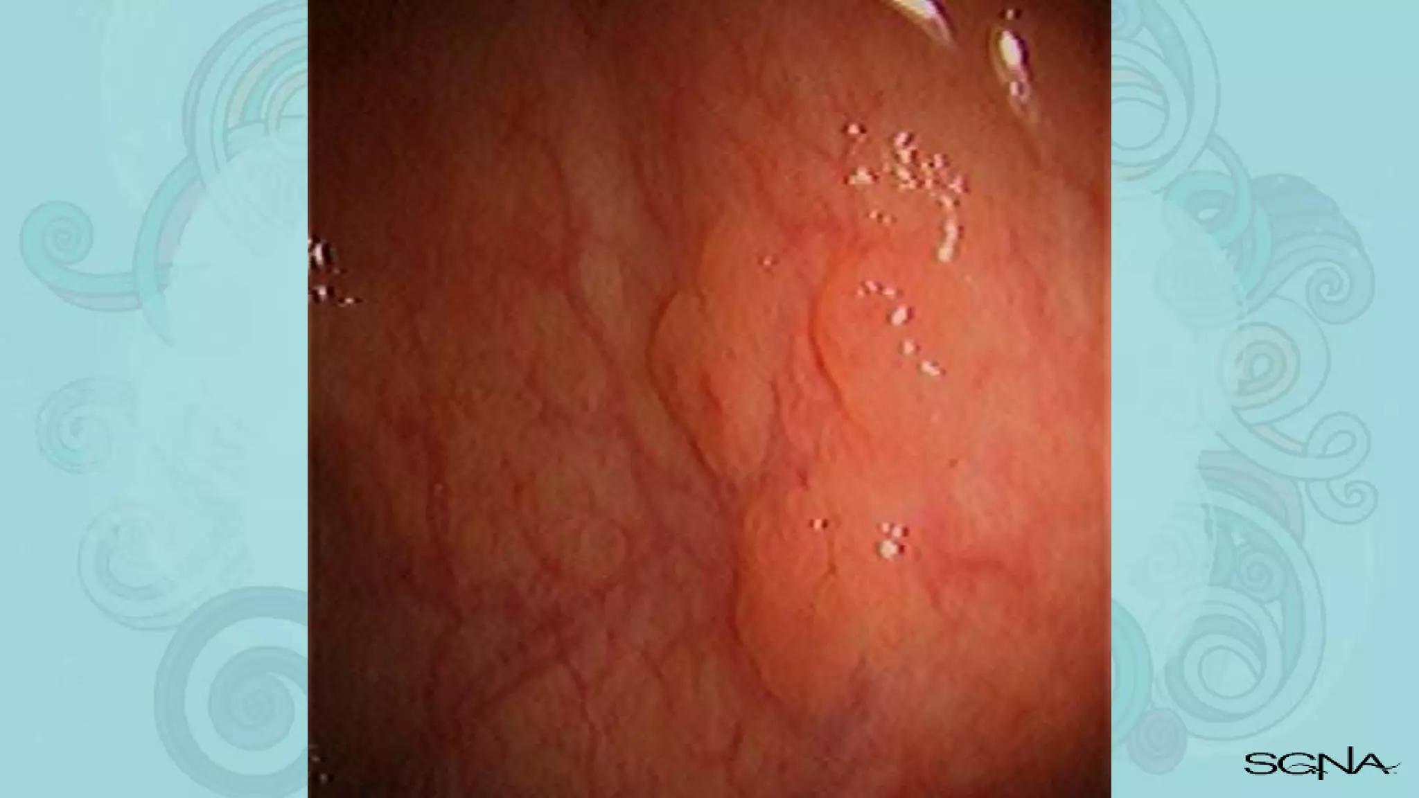 Kudos To You: Learning your Kudo Pit Patterns and Paris Polyp ...