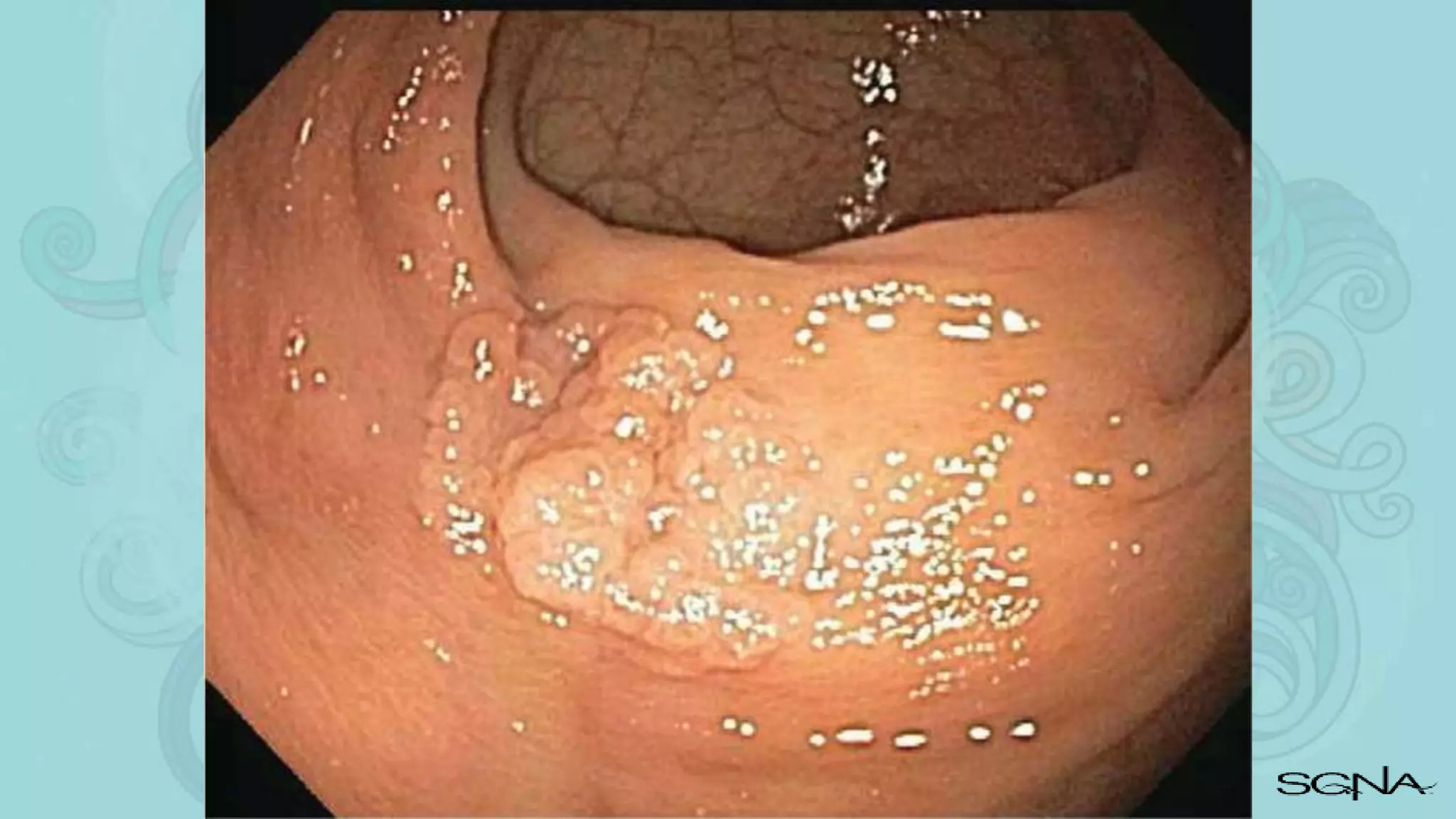 Kudos To You: Learning your Kudo Pit Patterns and Paris Polyp ...