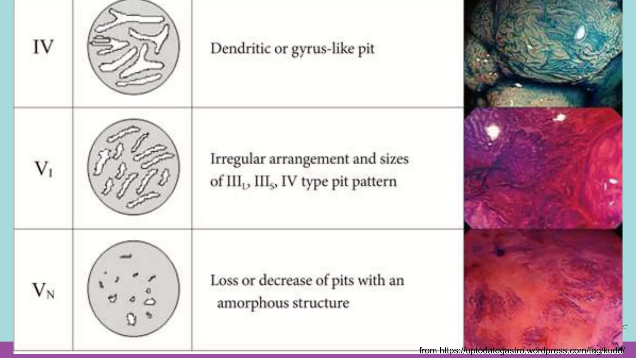 Kudos To You: Learning your Kudo Pit Patterns and Paris Polyp ...