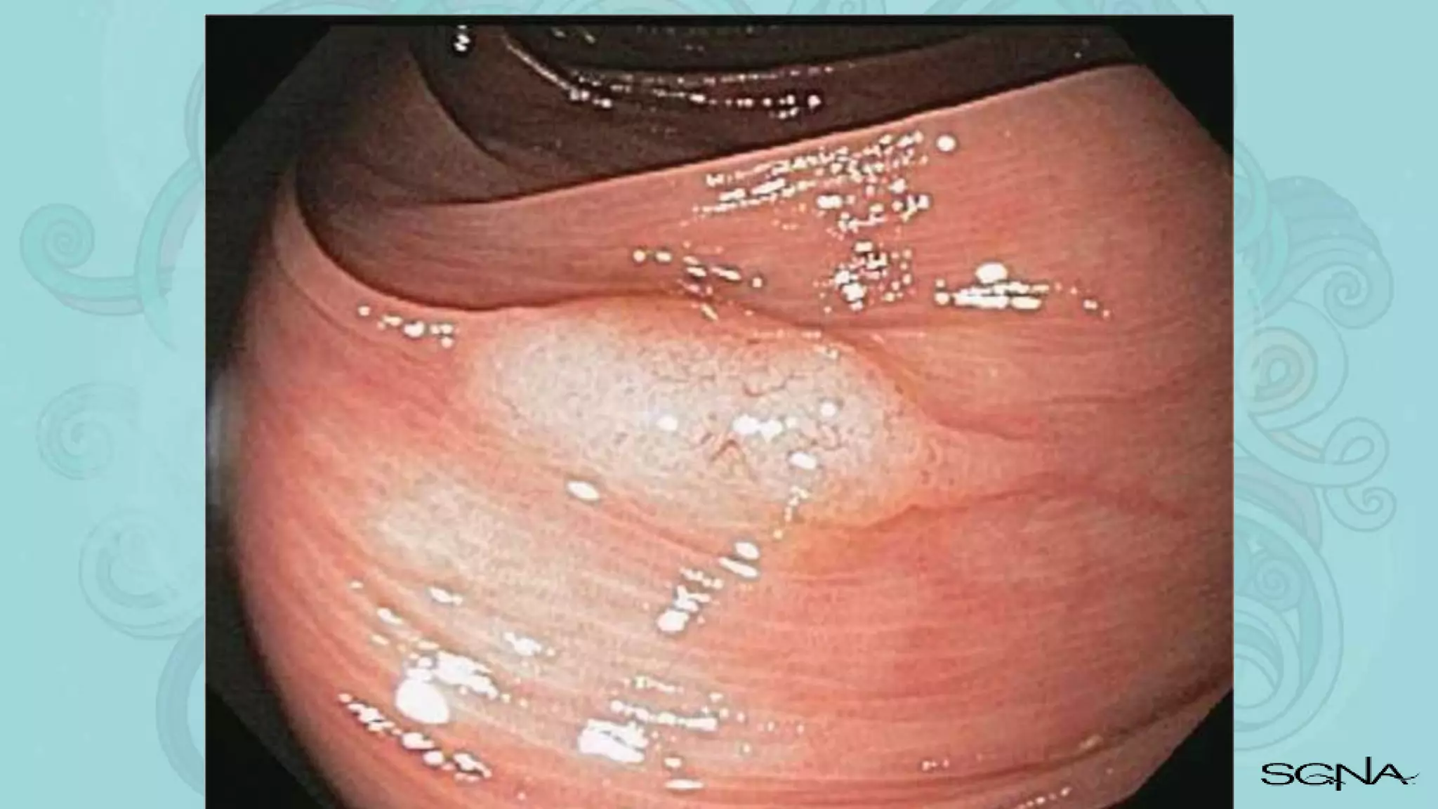 Kudos To You: Learning your Kudo Pit Patterns and Paris Polyp ...