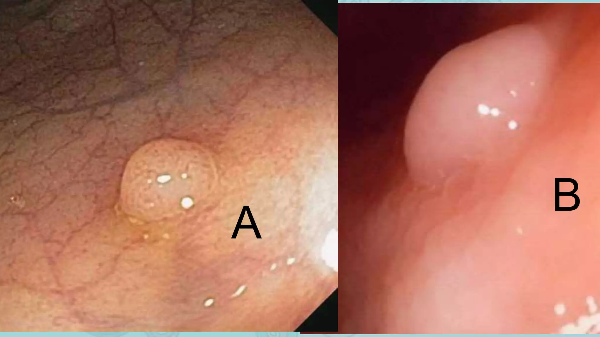 Kudos To You: Learning your Kudo Pit Patterns and Paris Polyp ...