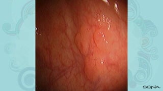 Kudos To You: Learning your Kudo Pit Patterns and Paris Polyp ...