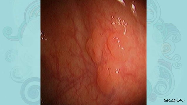 Kudos To You: Learning your Kudo Pit Patterns and Paris Polyp ...