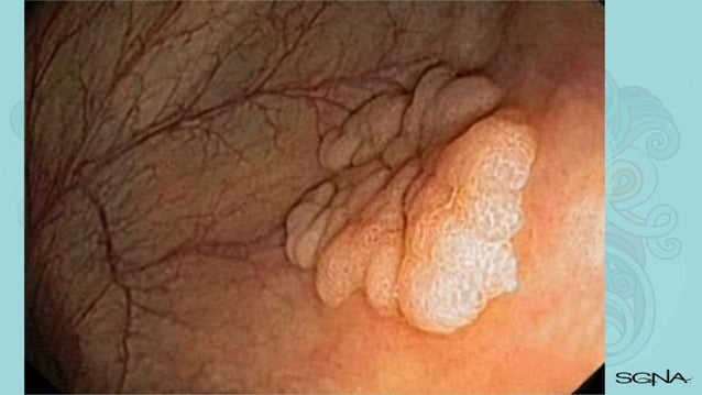 Kudos To You: Learning your Kudo Pit Patterns and Paris Polyp ...