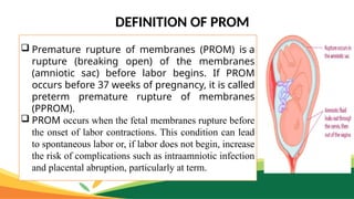 KULIAH BLOK 16 SISTEM REPRODUKSI_Premature Rupture of Membrane, Oligo ...