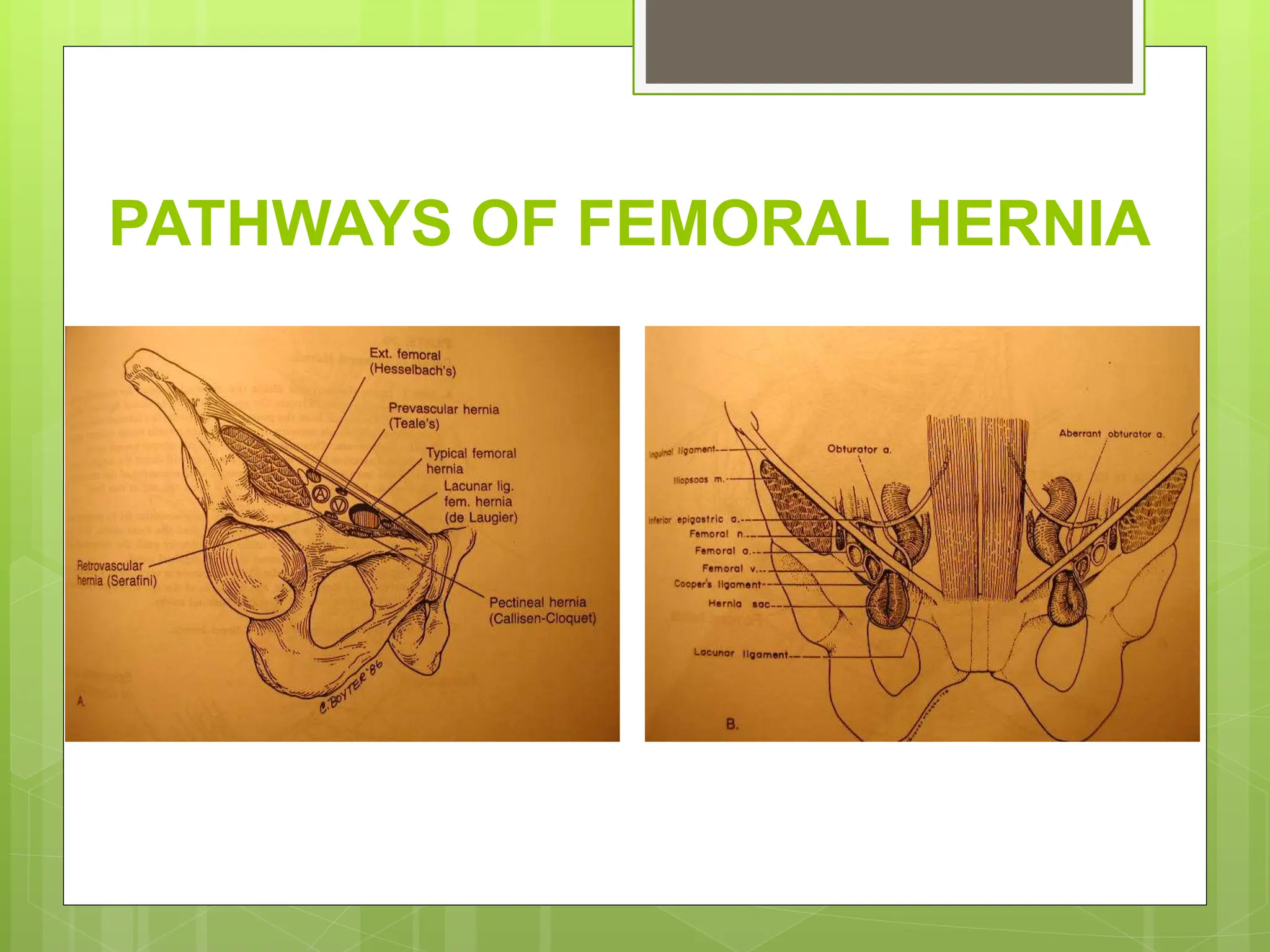 prsentasii dan edukasi Kuliah Hernia RW.PPT