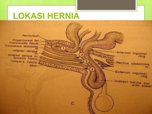 prsentasii dan edukasi Kuliah Hernia RW.PPT