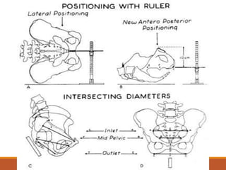 Kuliah penyegaran parturition, 7 cardinal movements, pelvimetri | PPTX