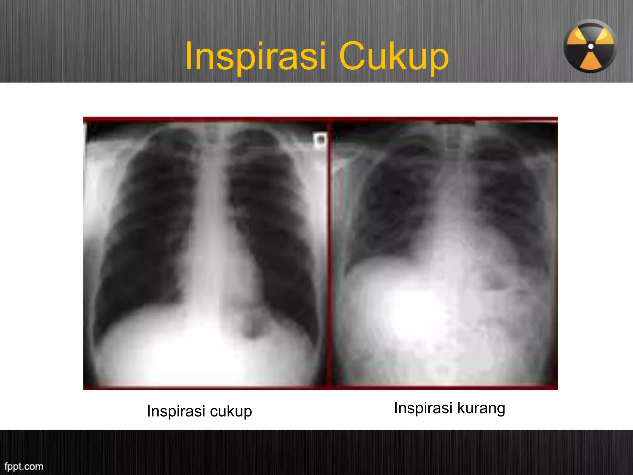 KULIAH RADIOGRAFI TORAKS NORMAL, blok 4.pdf