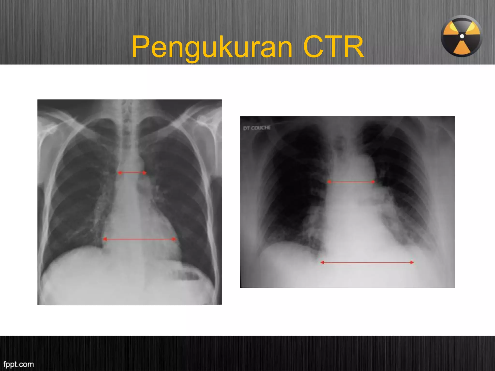 KULIAH RADIOGRAFI TORAKS NORMAL, blok 4.pdf