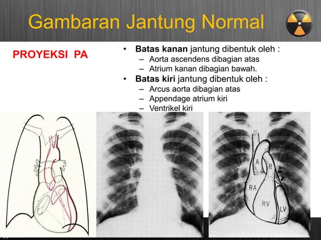 KULIAH RADIOGRAFI TORAKS NORMAL, blok 4.pdf