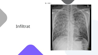 Kuliah Dasar Radiologi dan Patologi Toraks | PPTX