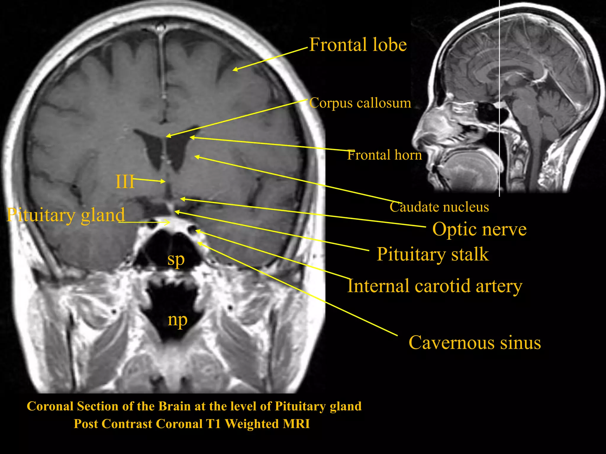 MRI SECTIONAL ANATOMY OF BRAIN | PPTX