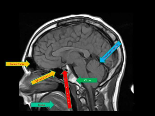 MRI SECTIONAL ANATOMY OF BRAIN | PPTX