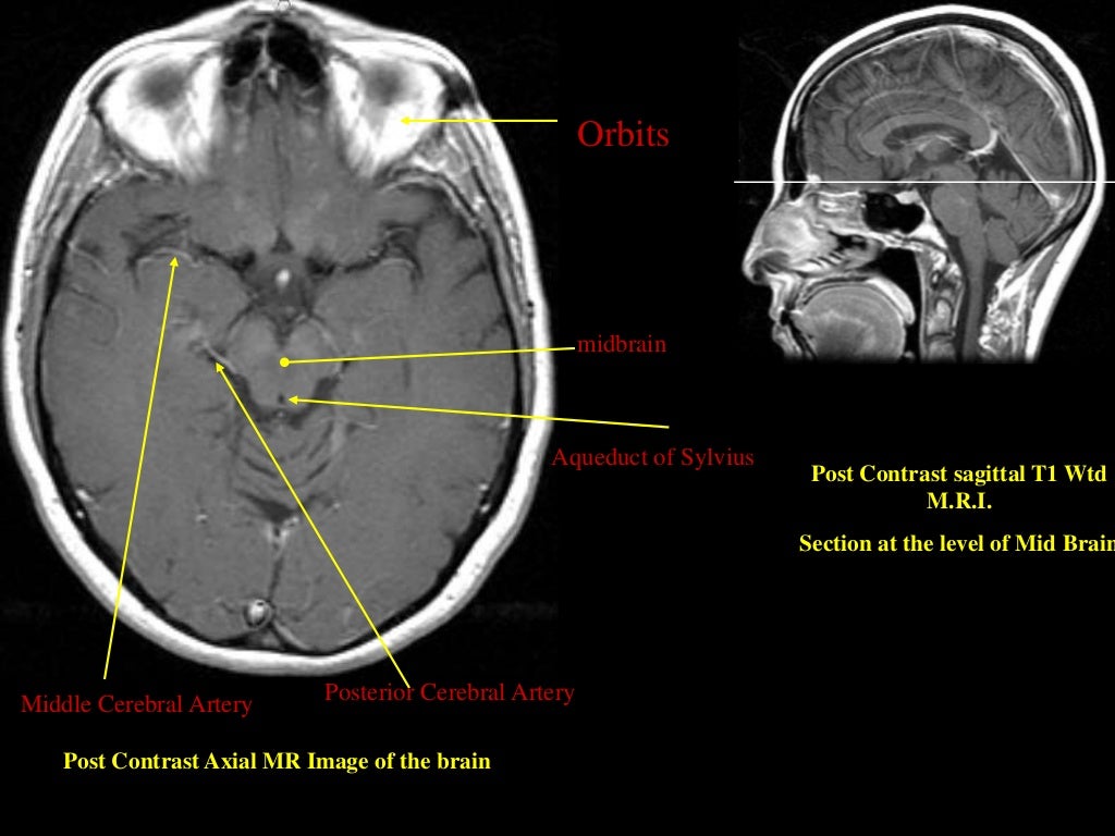 MRI SECTIONAL ANATOMY OF BRAIN