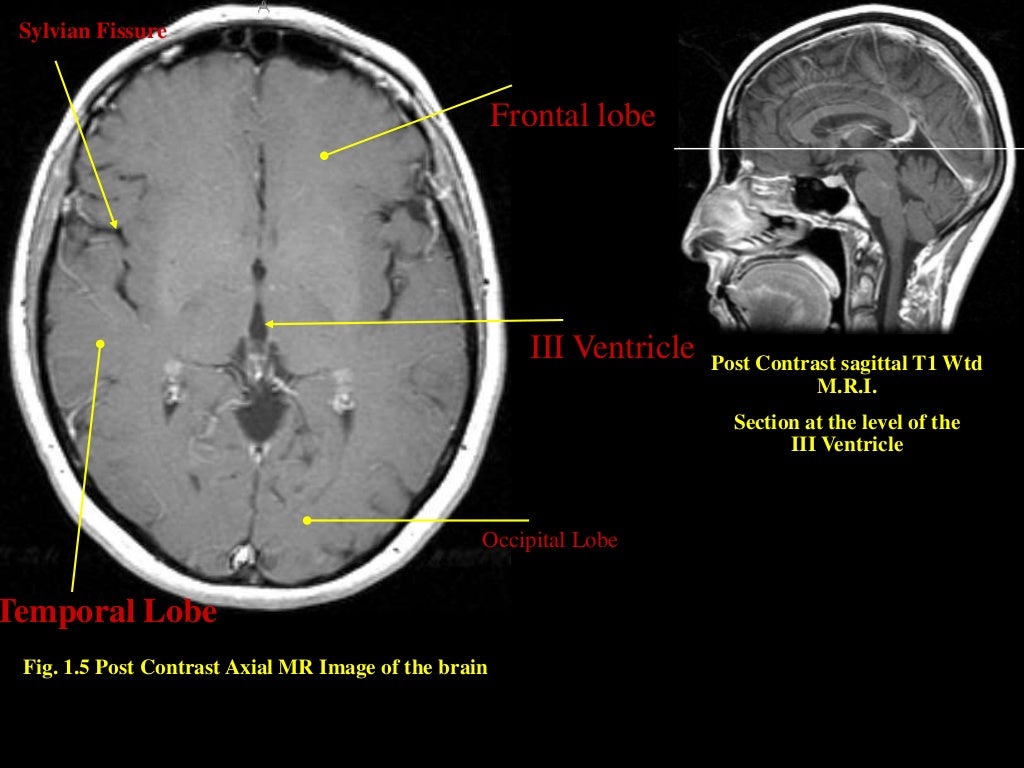 MRI SECTIONAL ANATOMY OF BRAIN