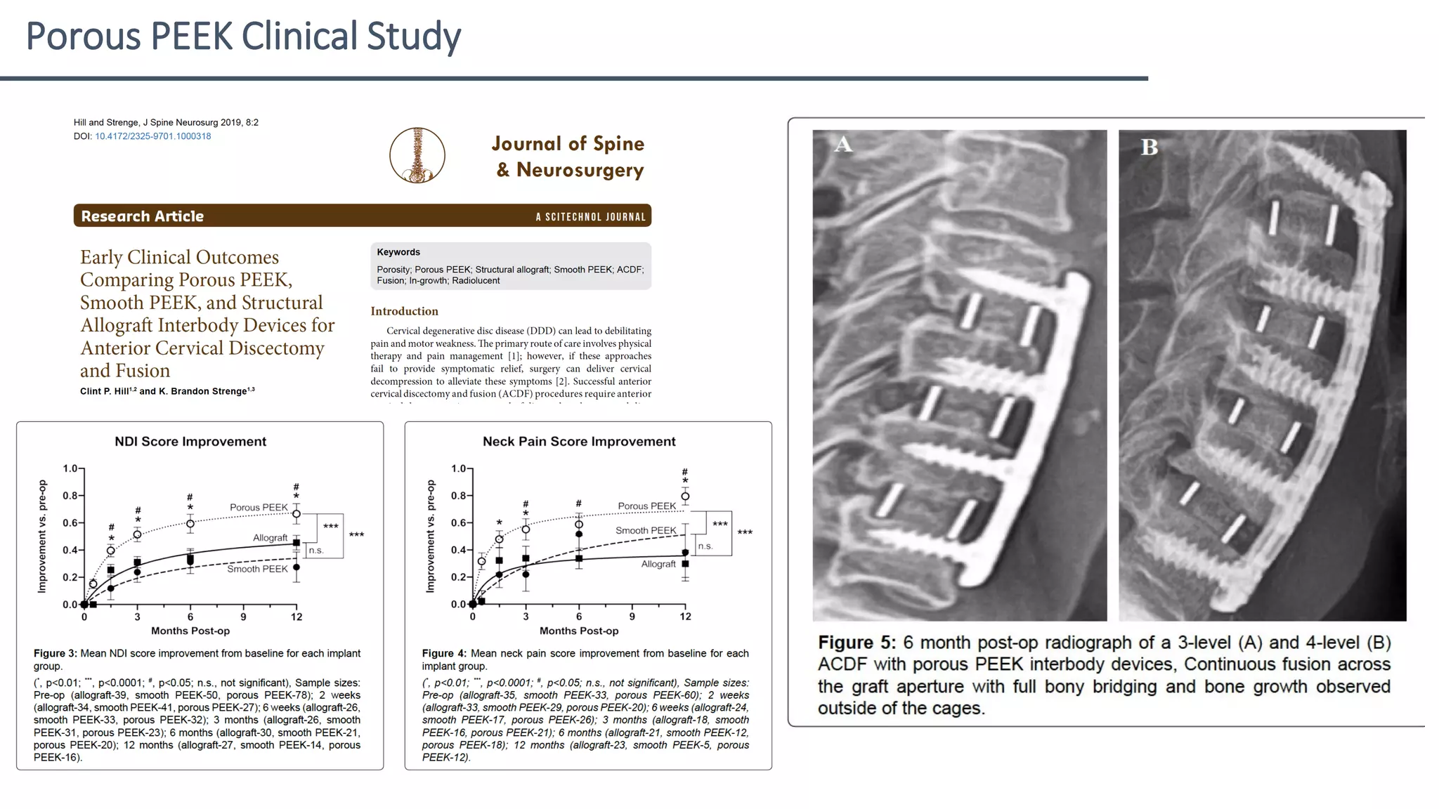 Spine Implants: Porous Coatings vs. Porous Materials vs. Additive ...
