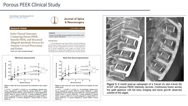 Spine Implants: Porous Coatings vs. Porous Materials vs. Additive ...