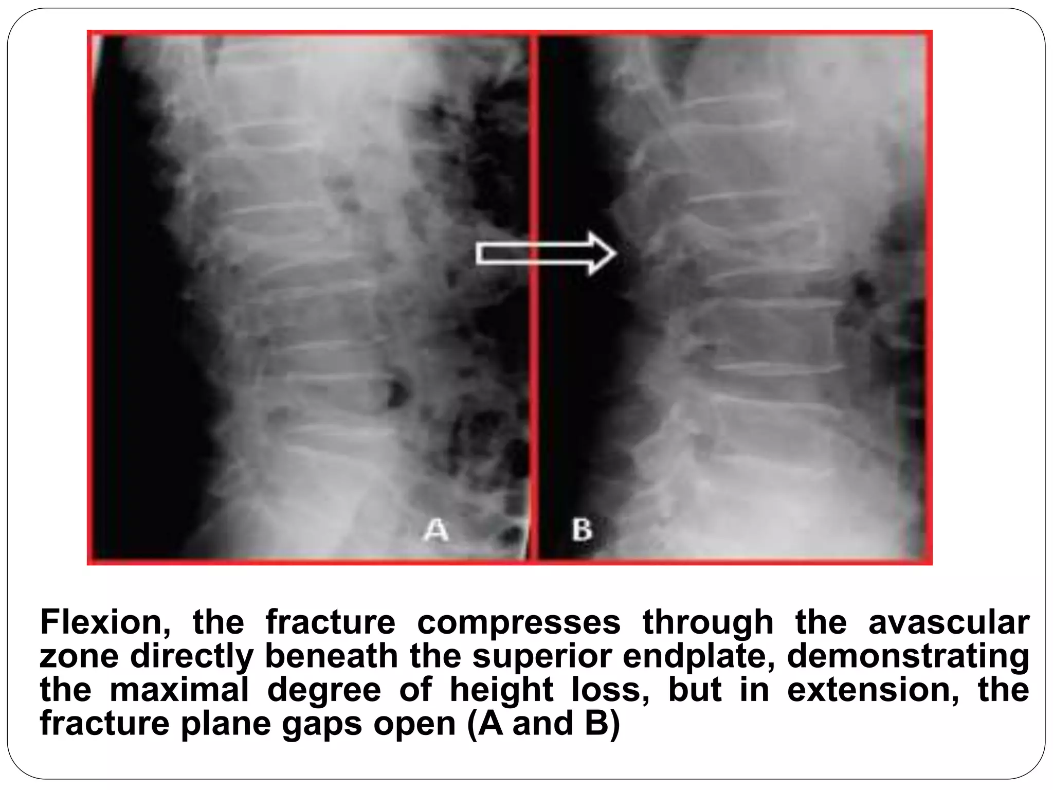 KUMMEL DISEASE.pptx