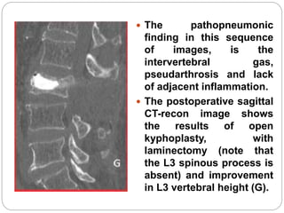 KUMMEL DISEASE.pptx