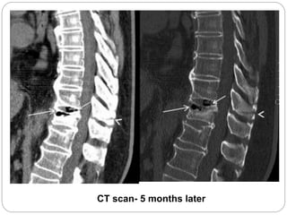 KUMMEL DISEASE.pptx