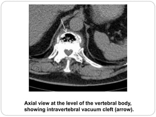 KUMMEL DISEASE.pptx