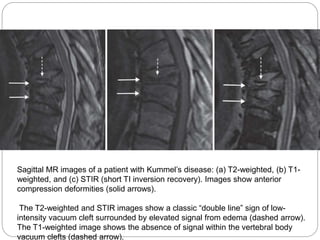 KUMMEL DISEASE.pptx