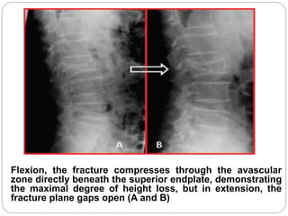 KUMMEL DISEASE.pptx