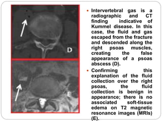 KUMMEL DISEASE.pptx