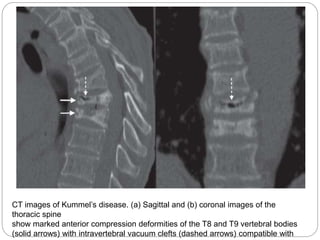 KUMMEL DISEASE.pptx