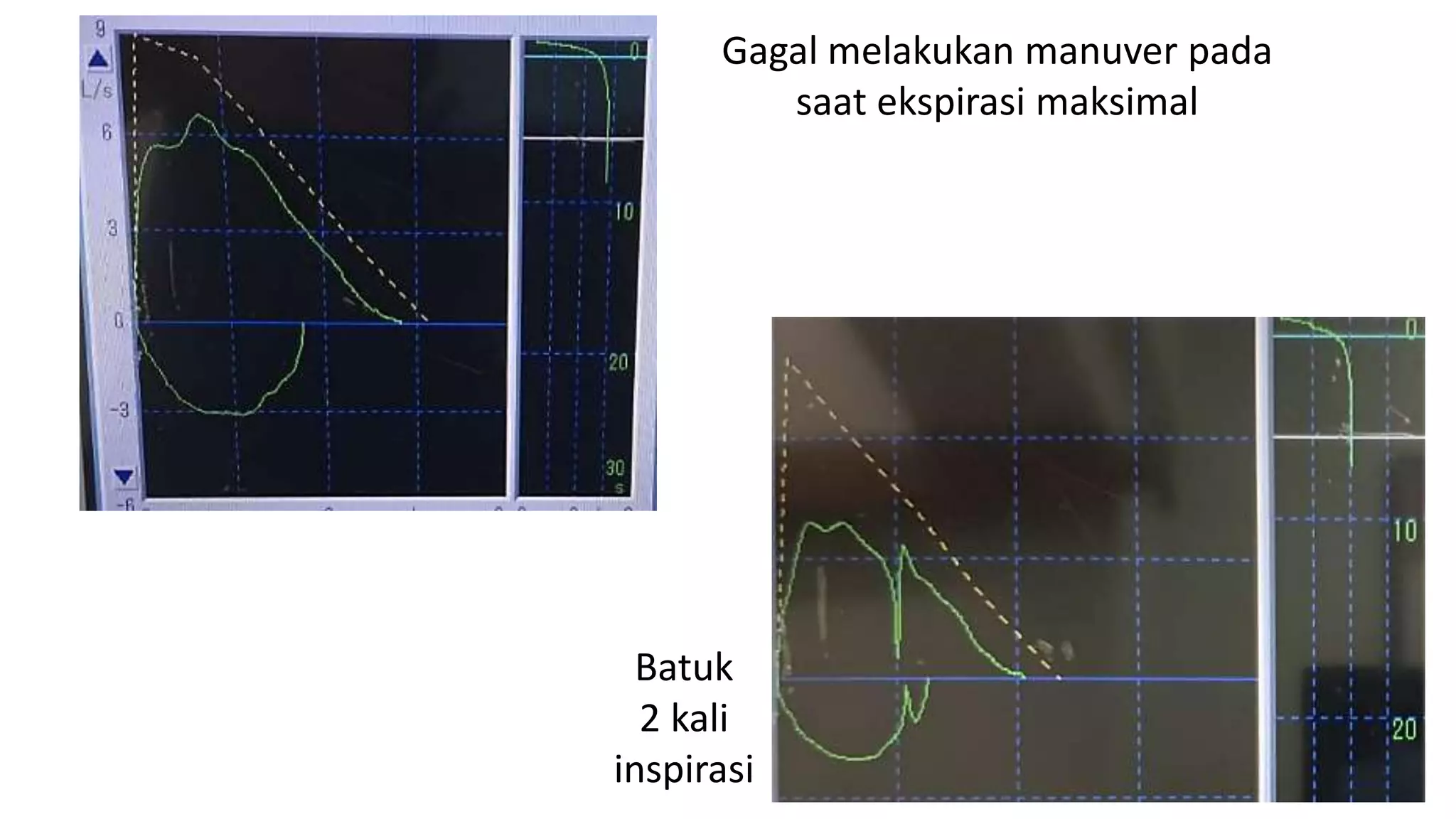 Kumpulan Spirometri Cases Final.pptx