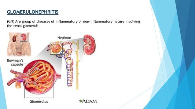 Glomerulonephritis topic kidney related disease | PPT