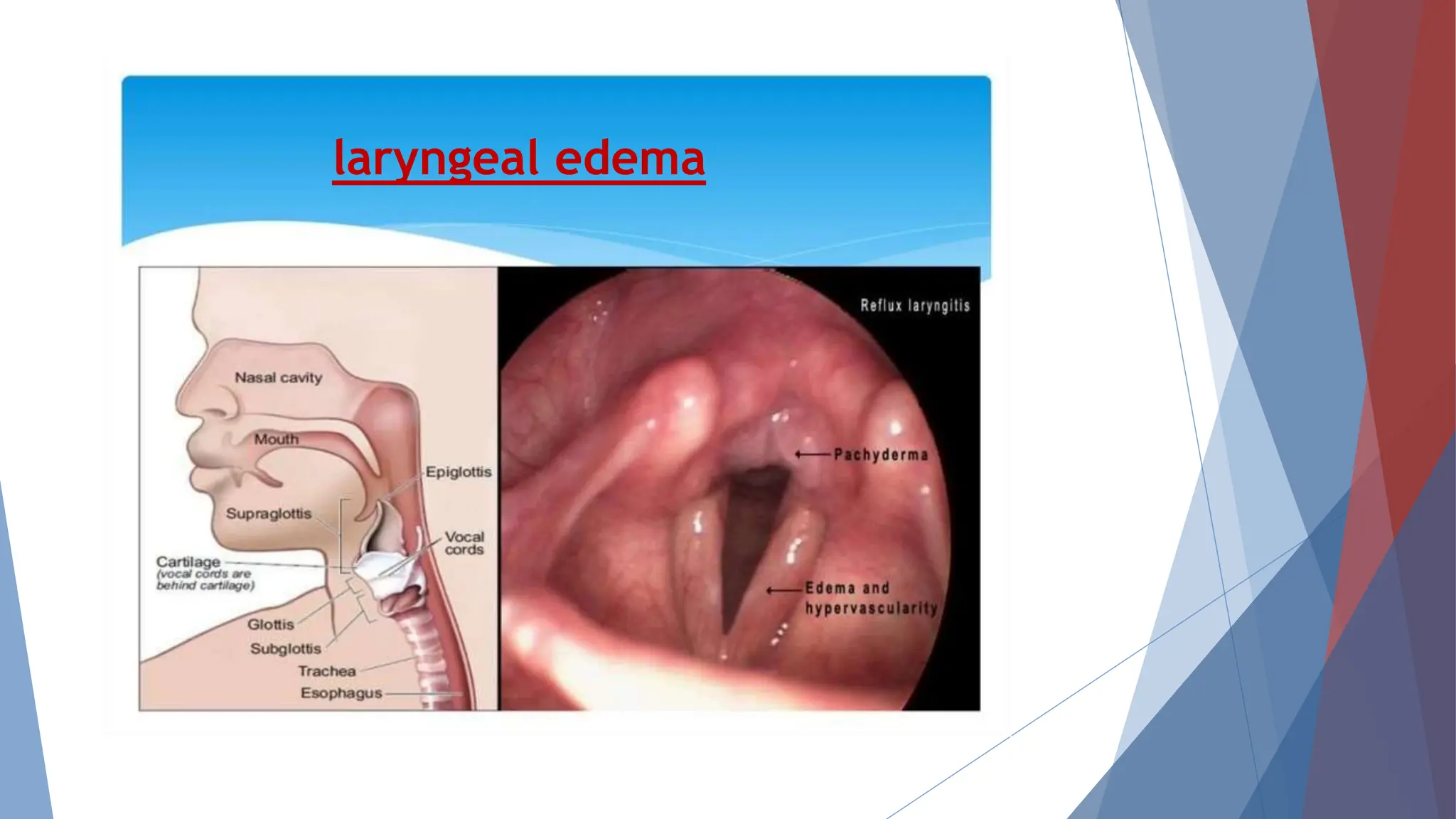 Kunal Singh .Topic-4.Diseases of the larynx.ENT.GM20-148.pptx