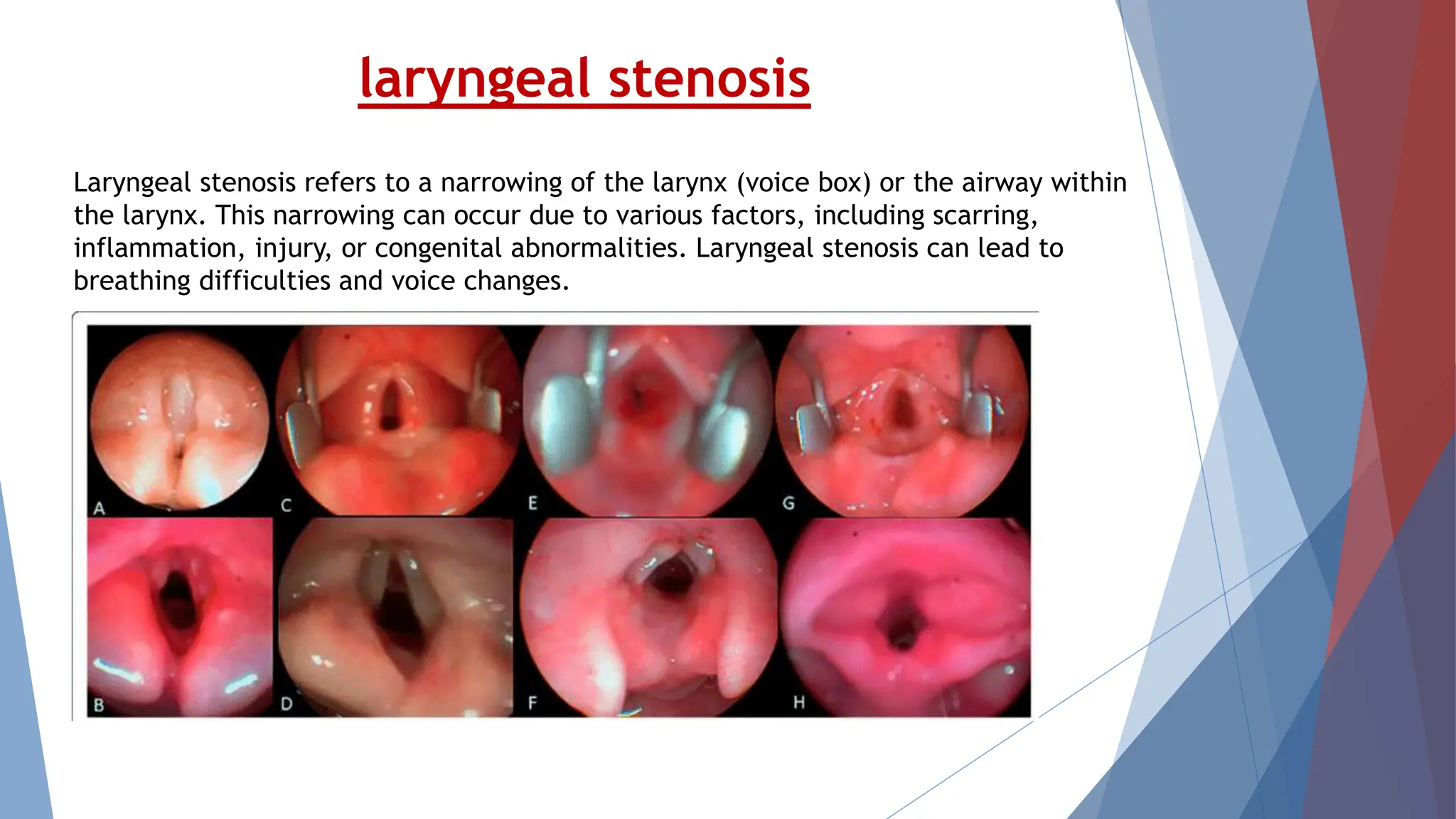 Kunal Singh .Topic-4.Diseases of the larynx.ENT.GM20-148.pptx