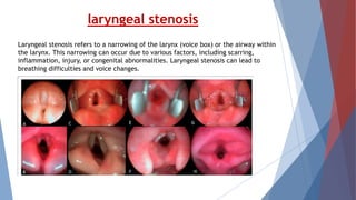 Kunal Singh .Topic-4.Diseases of the larynx.ENT.GM20-148.pptx