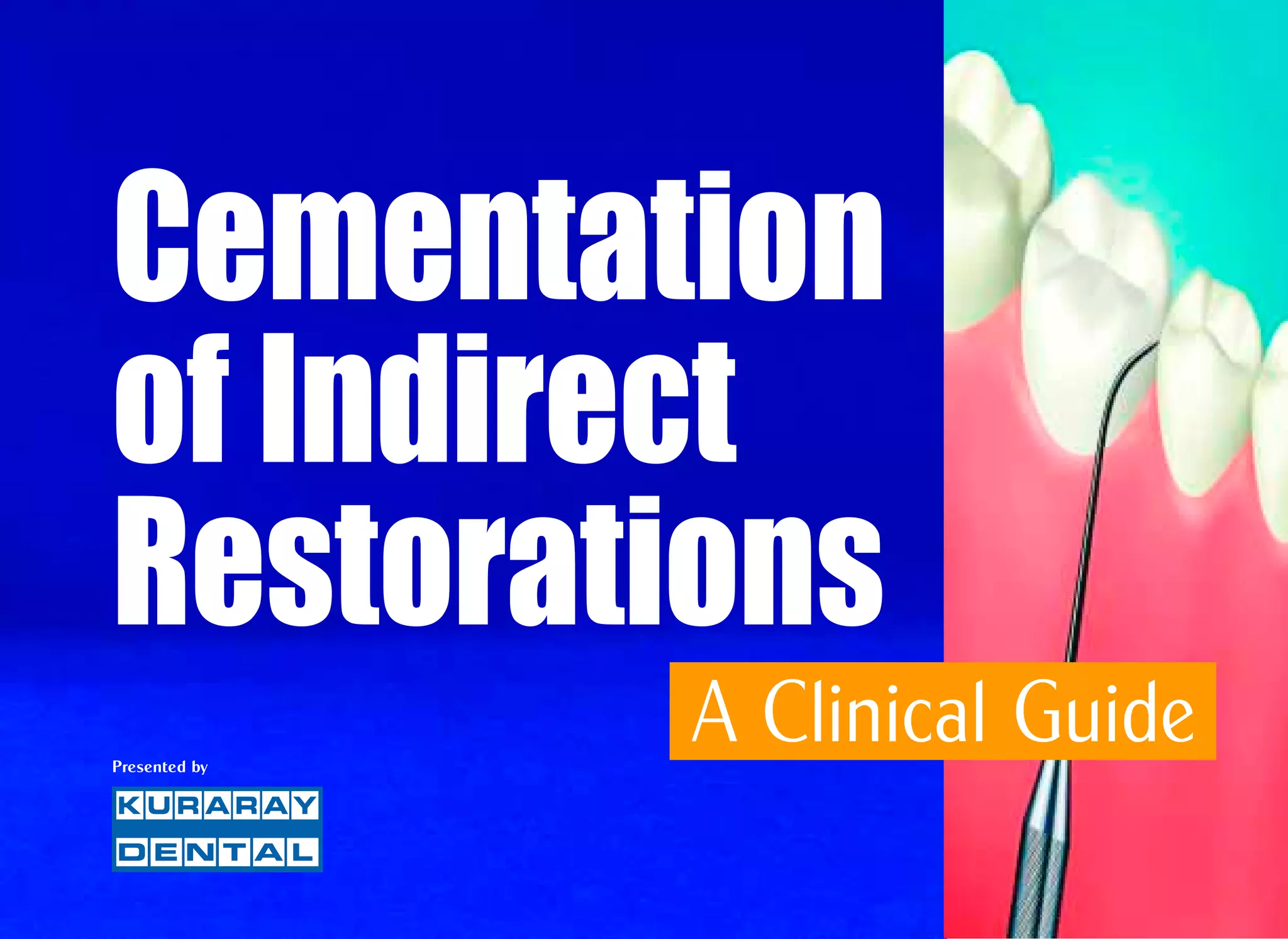 Kuraray cementation indirect_restorations_guide | PDF