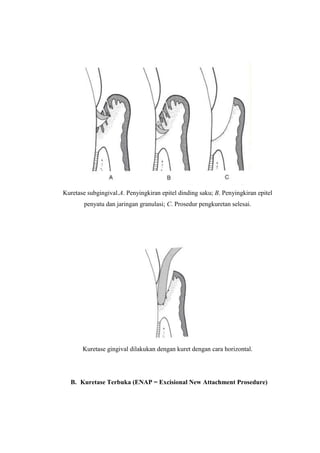 Kuretase | DOCX