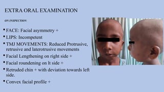 temporomandibular joint ankylosis ankylosis and its management | PPT