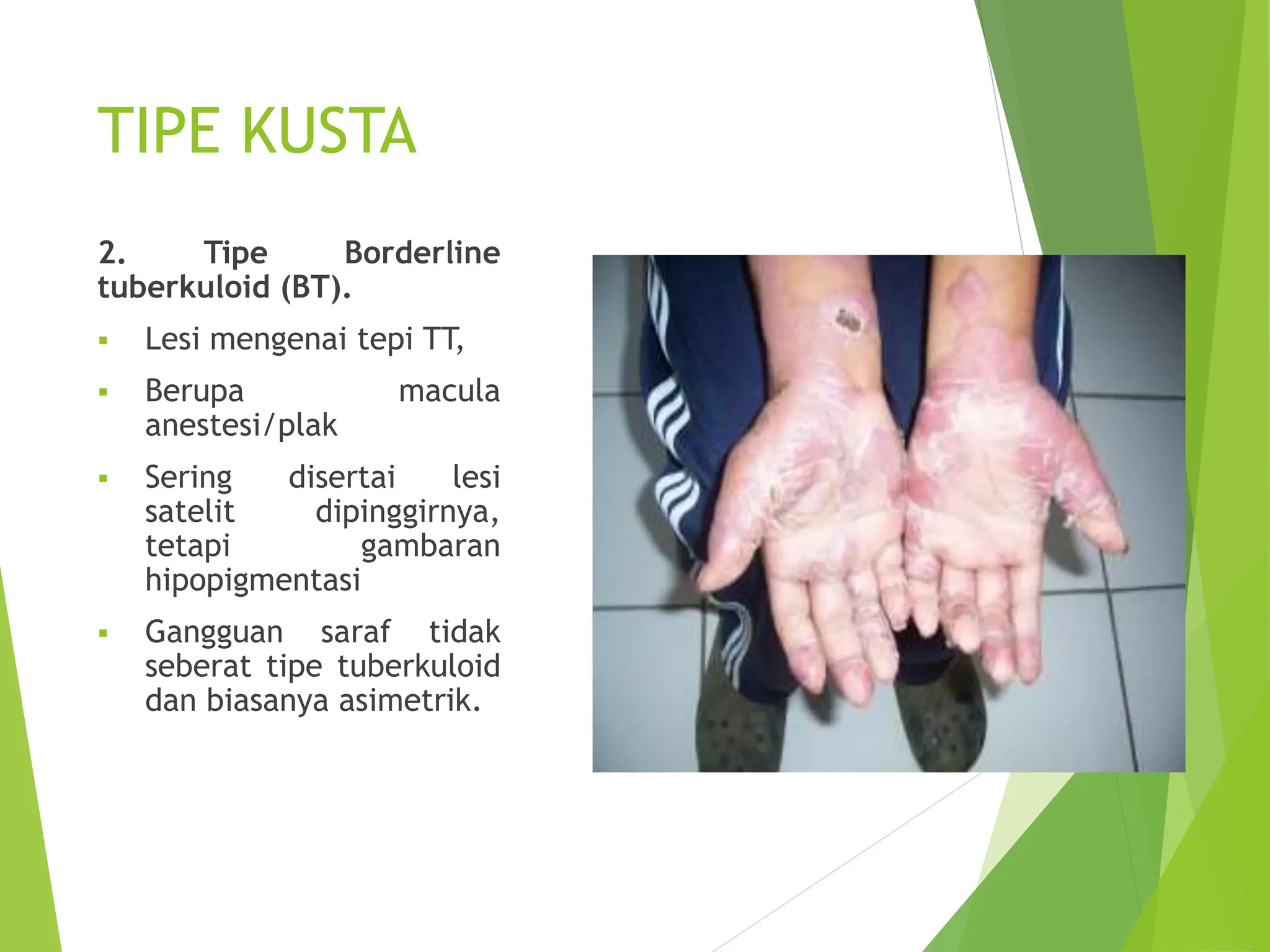 asuehan keperawatan pada pasien dengan penyakit kusta | PPTX