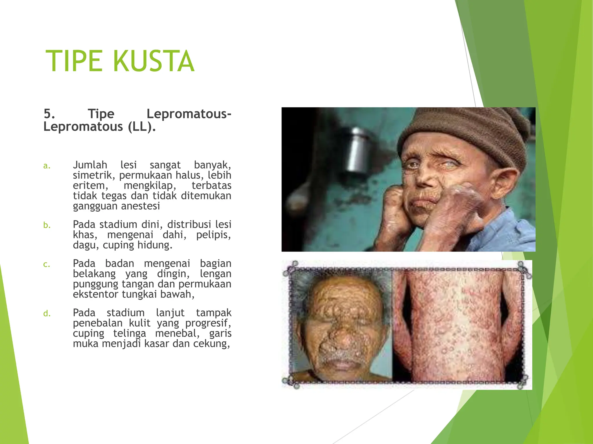 asuehan keperawatan pada pasien dengan penyakit kusta | PPTX