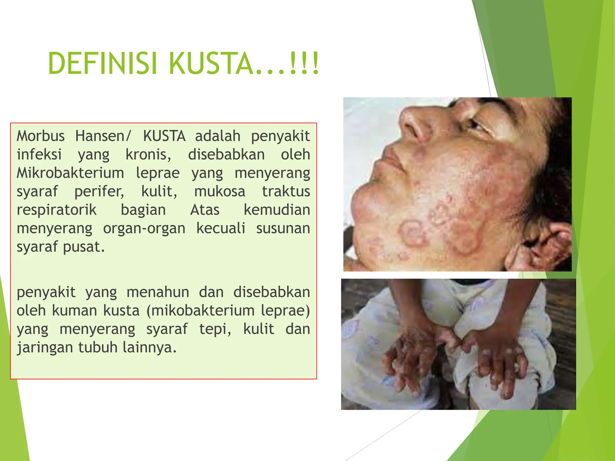 asuehan keperawatan pada pasien dengan penyakit kusta | PPTX