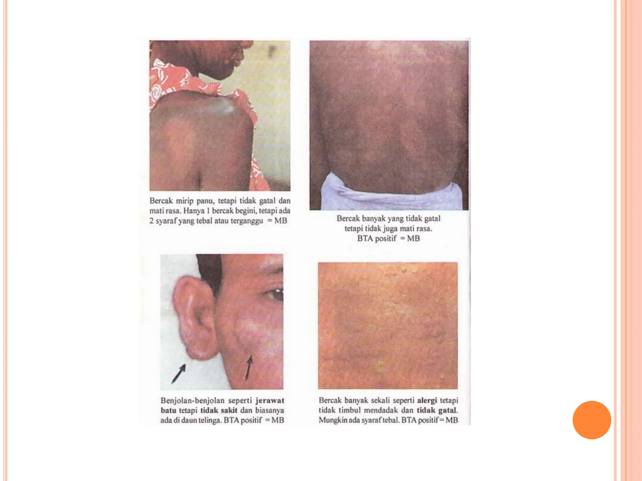 Laporan kasus kusta (morbus hansen).ppt