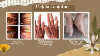 pengertian, tanda dan gejala dan penanganan kusta | PPTX