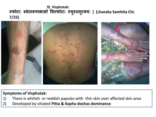 Kustha | PPTX | Skin and Dermatology | Diseases and Conditions